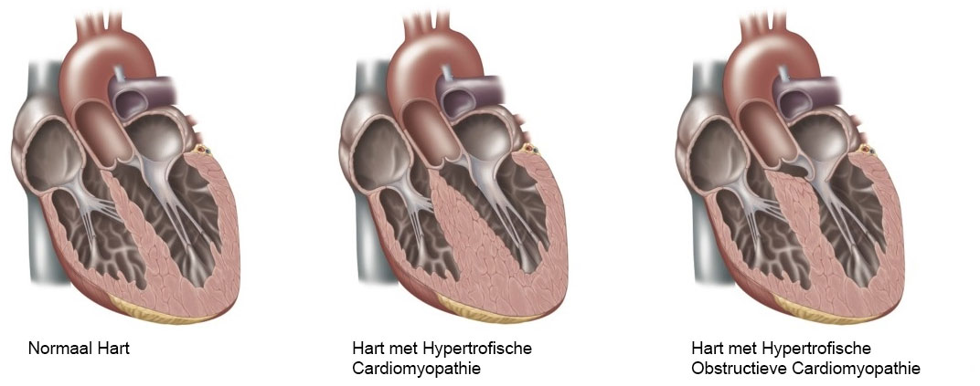 Hypertrofische Obstructieve Cardiomyopathie (HOCM) - Thorax Centrum Twente