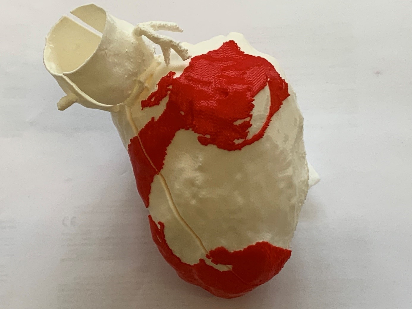 Hypertrofische Obstructieve Cardiomyopathie (HOCM) - Thorax Centrum Twente